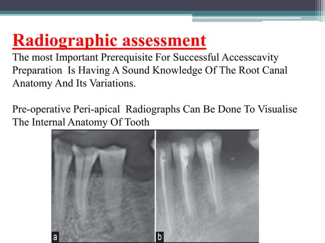 Anatomy of pulp canal and its access opening | PPT