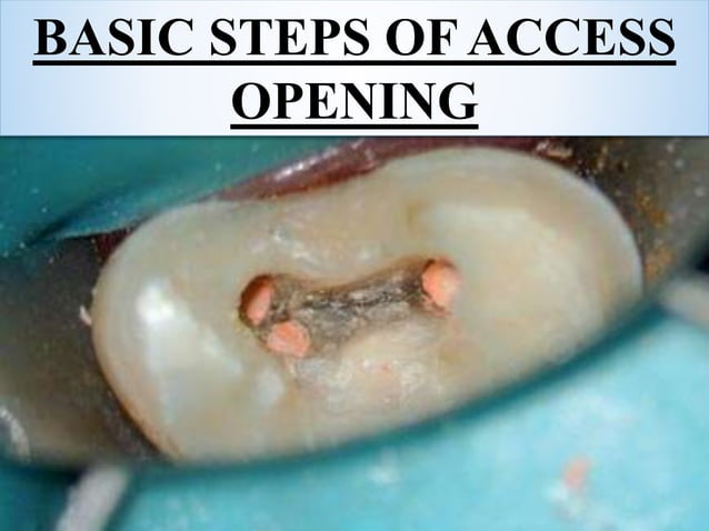 Anatomy of pulp canal and its access opening | PPT