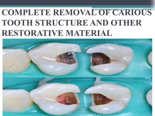 Anatomy of pulp canal and its access opening | PPT