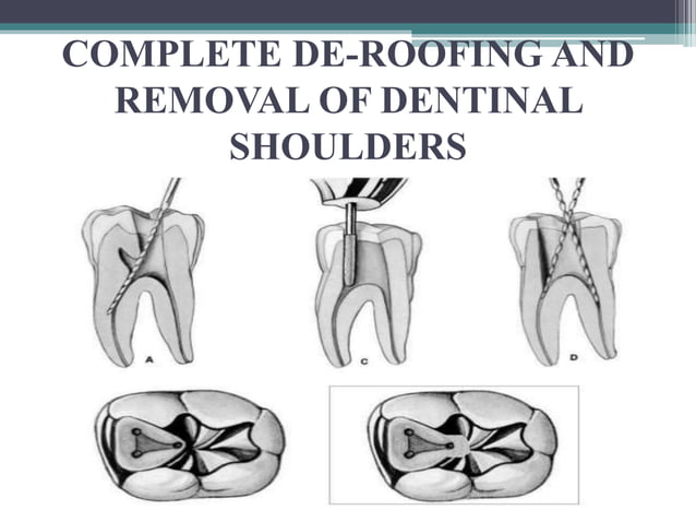Anatomy of pulp canal and its access opening | PPT