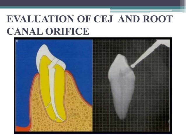 Anatomy of pulp canal and its access opening | PPT