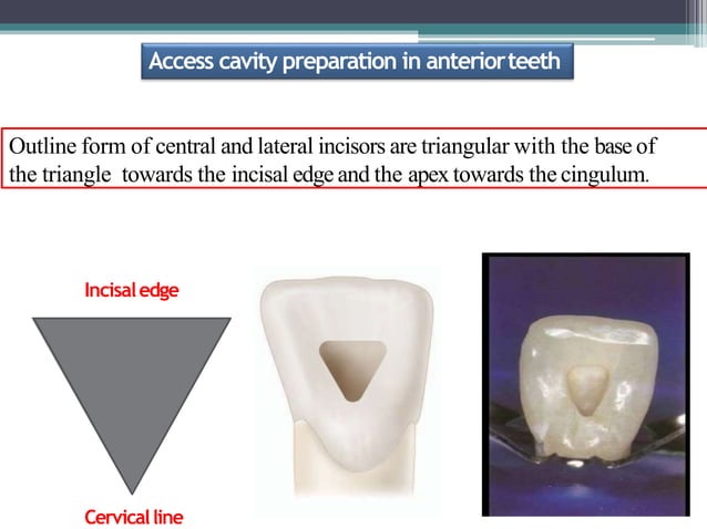 Anatomy of pulp canal and its access opening | PPT