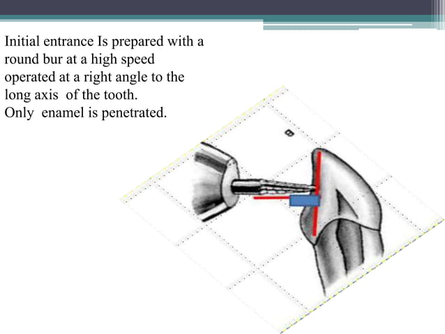 Anatomy of pulp canal and its access opening | PPT