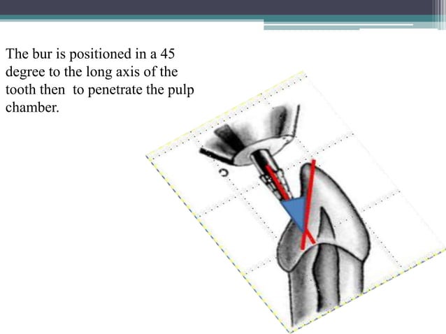 Anatomy of pulp canal and its access opening | PPT