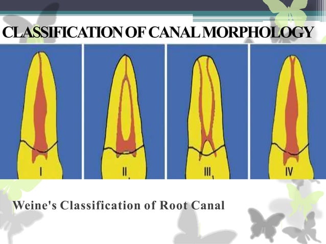Anatomy of pulp canal and its access opening | PPT