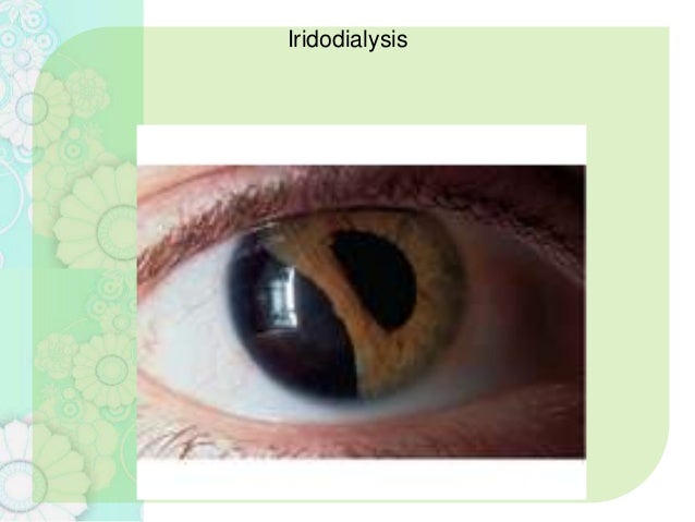 Cataract Surgery Pupil Shape