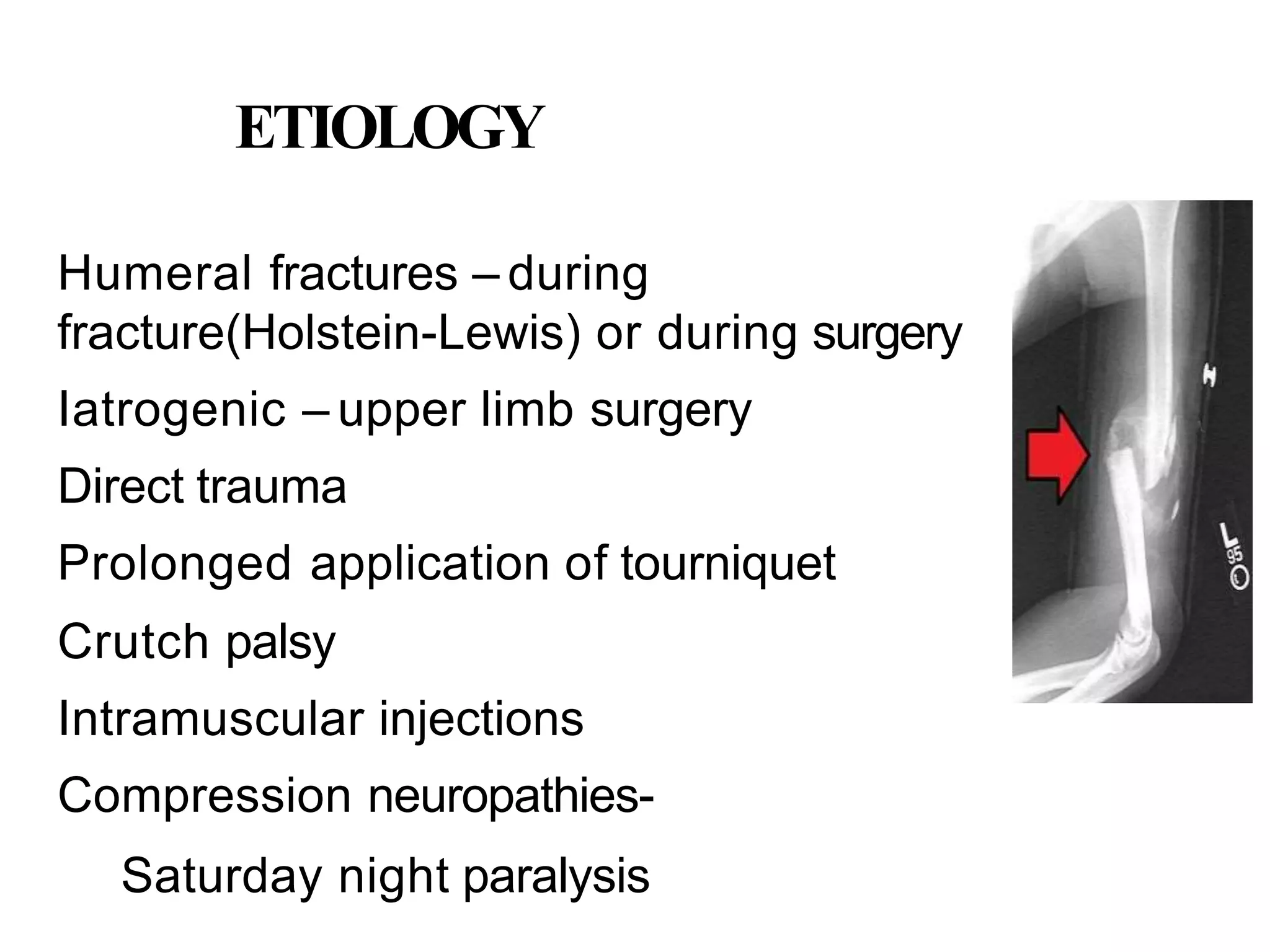 Anatomy of radial nerve and wrist drop | PPTX