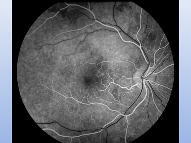 Anatomy of Retina | PPT | Eye and Vision Conditions | Diseases and ...