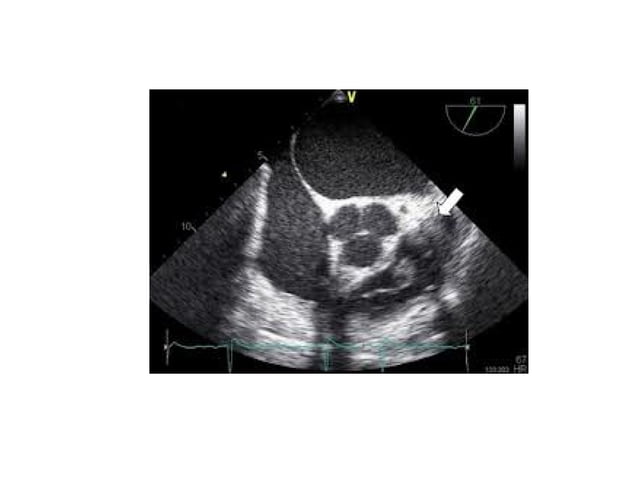anatomyofrightatrium of heart in detailed | PPT