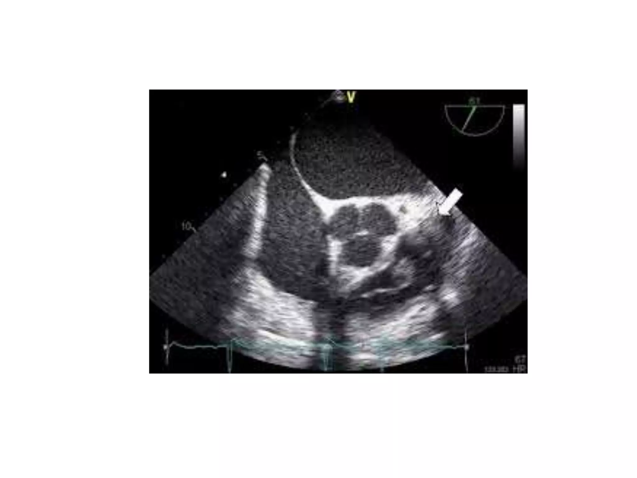 Anatomy of right atrium | PPTX