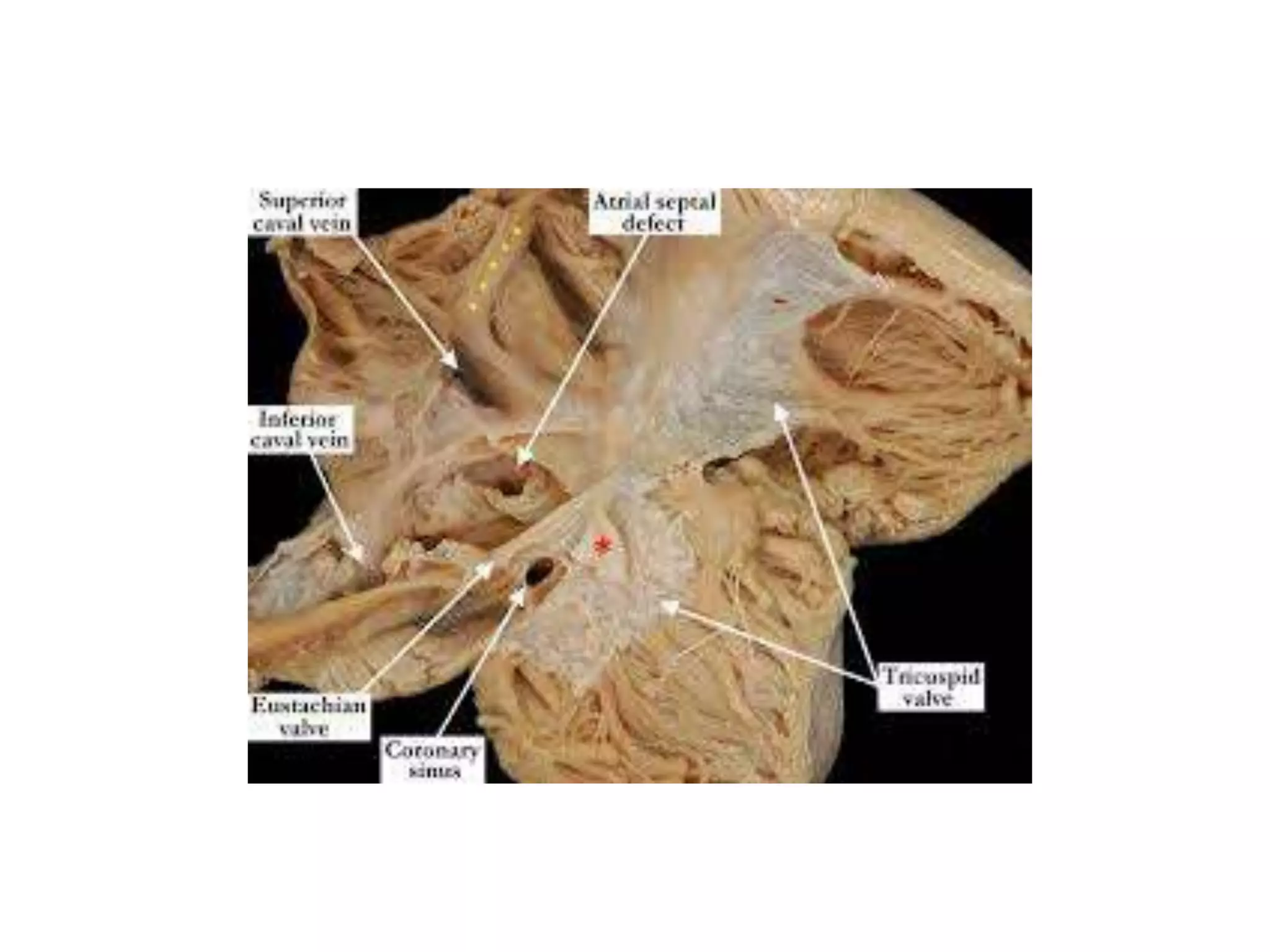Anatomy of right atrium | PPTX