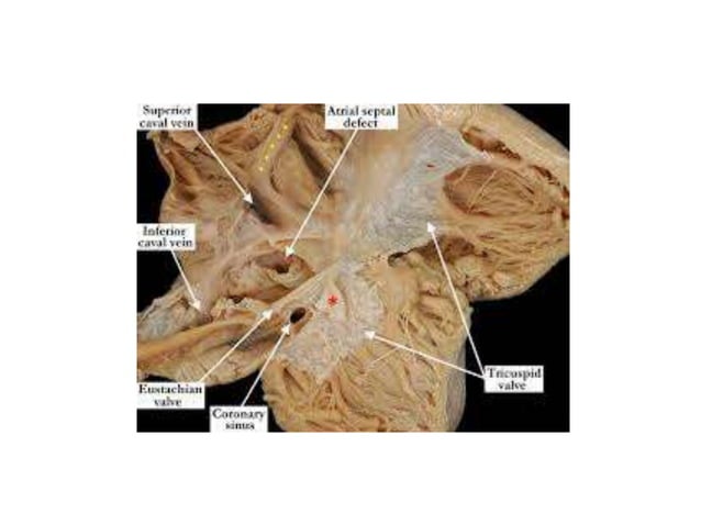 Anatomy of right atrium | PPTX | Heart and Cardiovascular Diseases ...