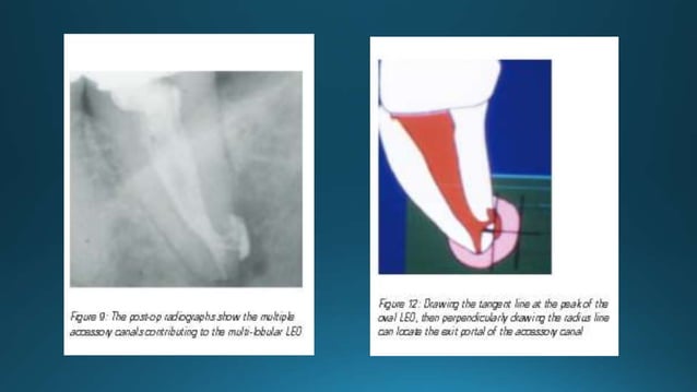 Anatomy of root apex and its significance new | PPTX | Dental Health ...