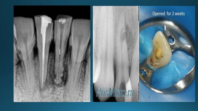 Anatomy of root apex and its significance new | PPT