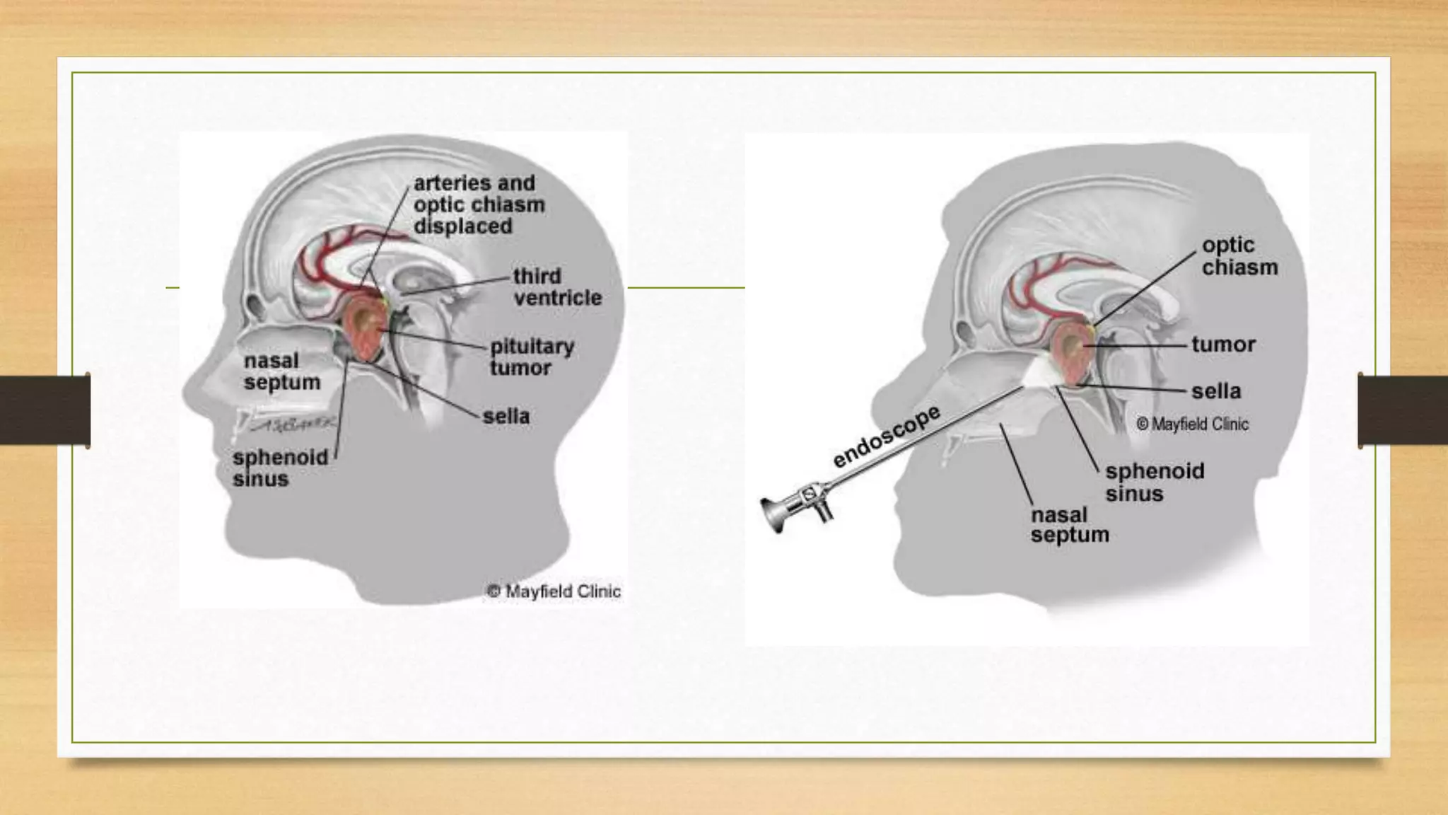 Anatomy of sellar suprasellar region | PPTX