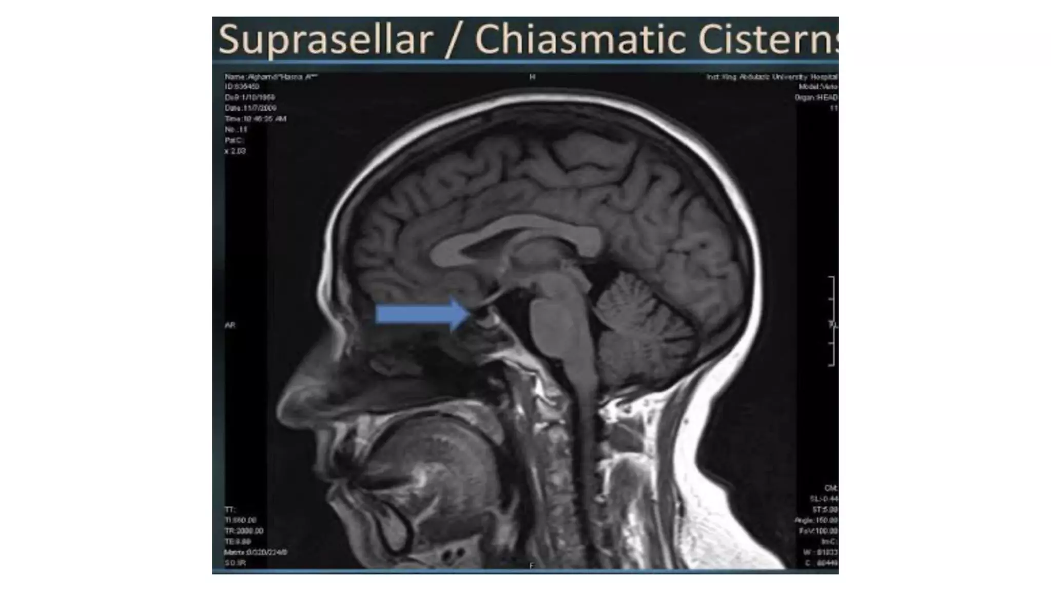 ANATOMY OF SUBARACHNOID CISTERNS OF BRAIN | PPTX