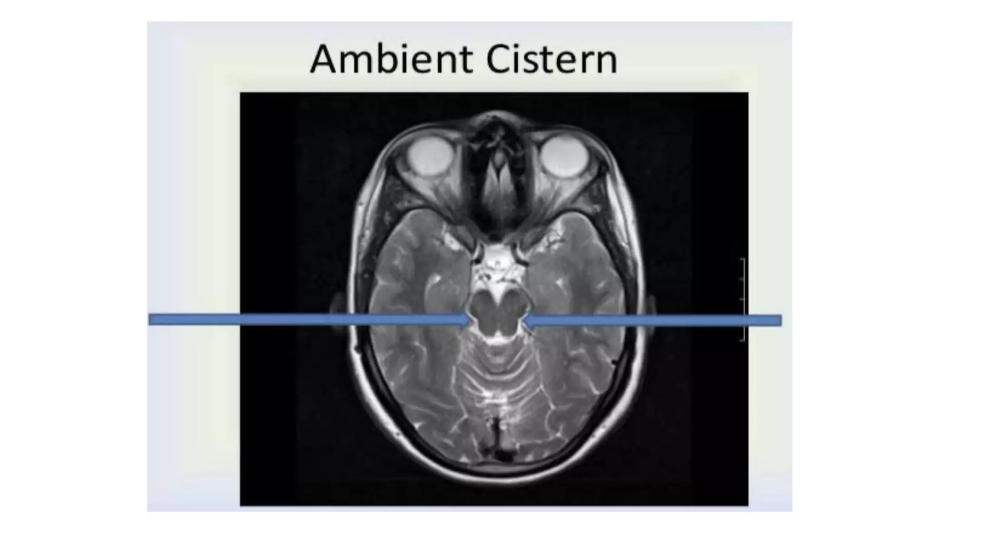 ANATOMY OF SUBARACHNOID CISTERNS OF BRAIN | PPTX