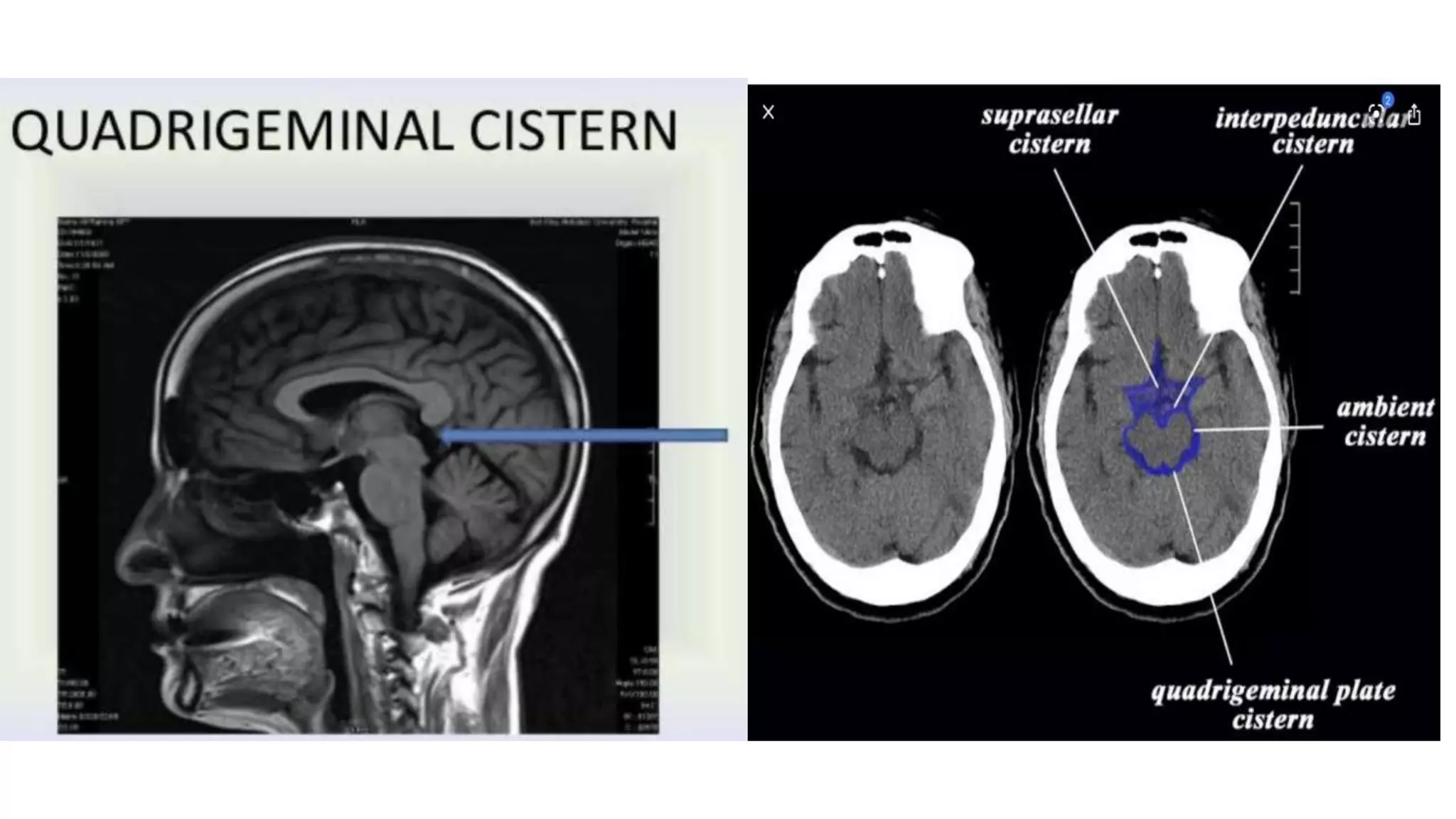 ANATOMY OF SUBARACHNOID CISTERNS OF BRAIN | PPTX
