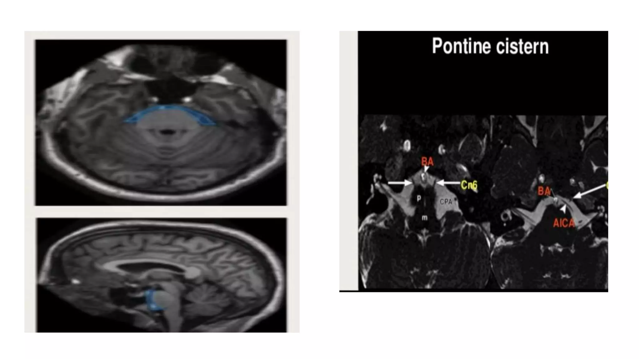 ANATOMY OF SUBARACHNOID CISTERNS OF BRAIN | PPTX