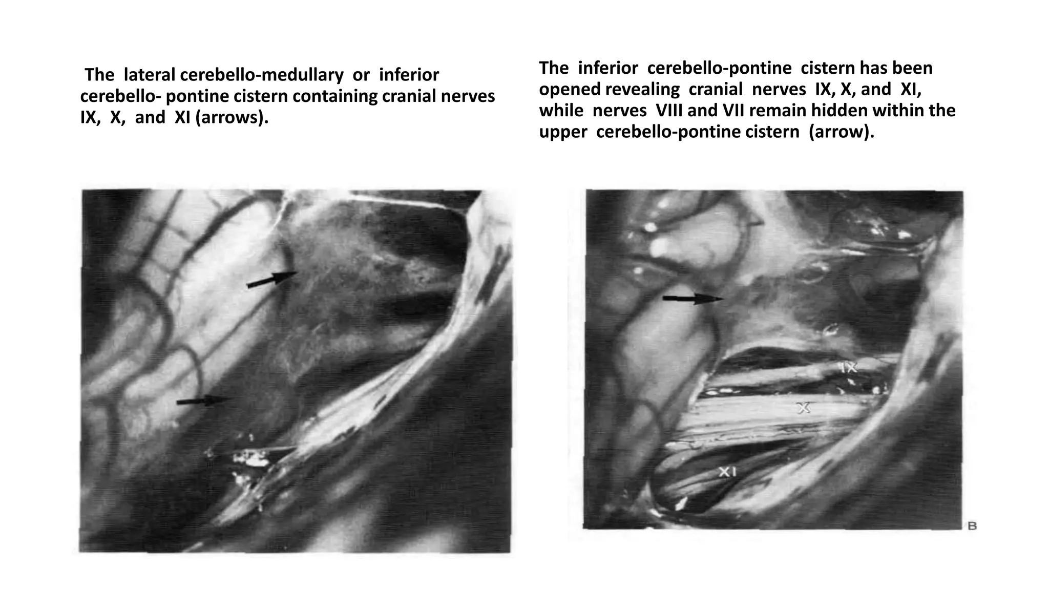 ANATOMY OF SUBARACHNOID CISTERNS OF BRAIN | PPTX
