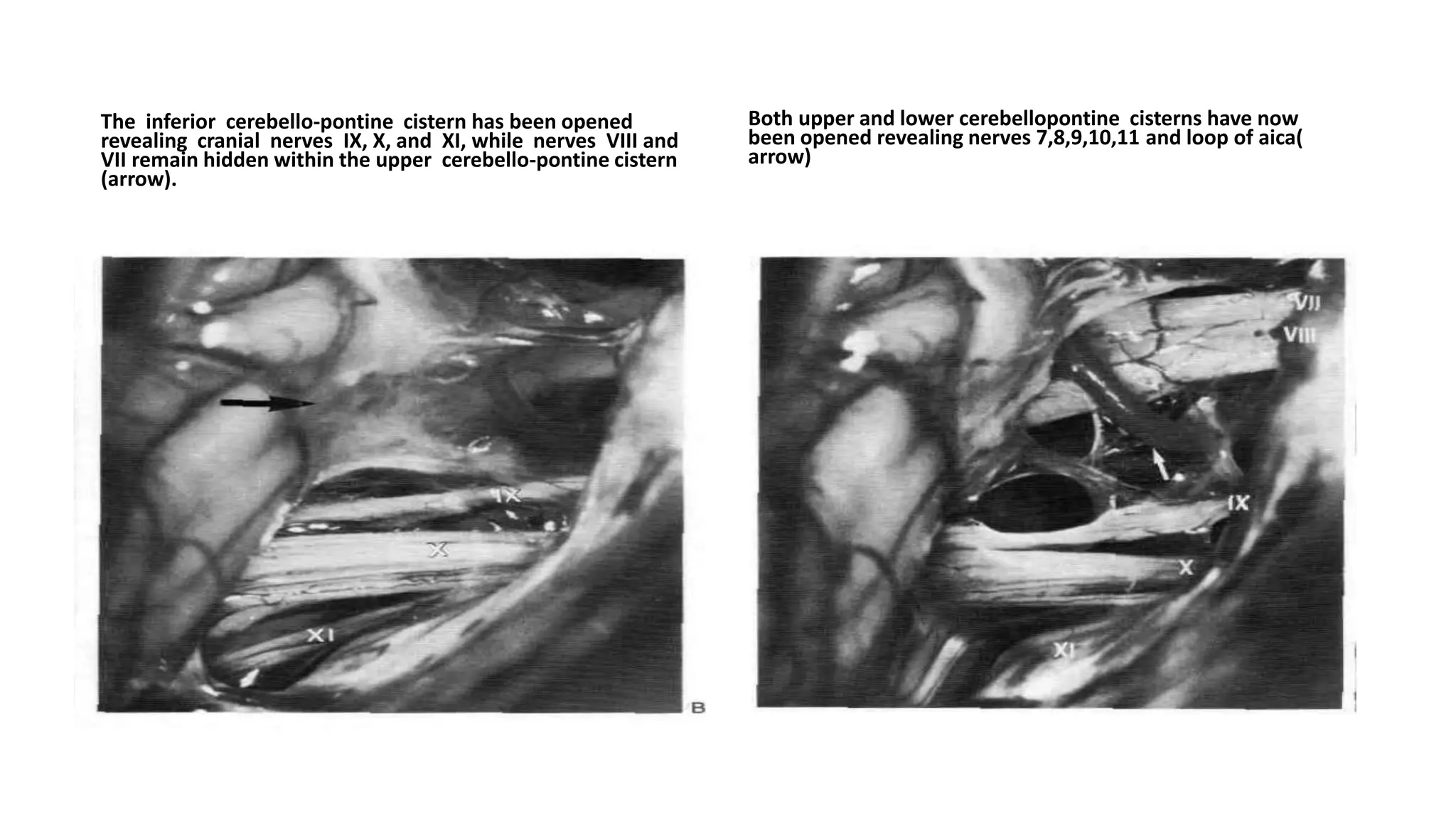 ANATOMY OF SUBARACHNOID CISTERNS OF BRAIN | PPTX