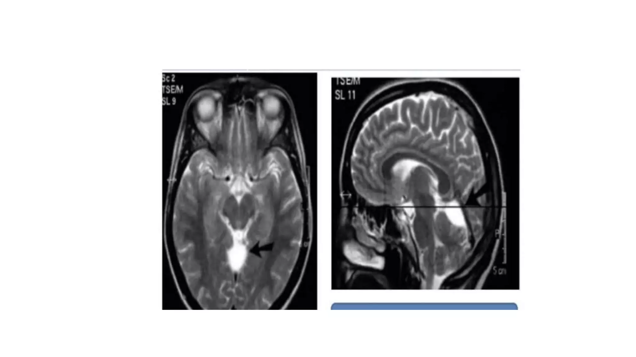 ANATOMY OF SUBARACHNOID CISTERNS OF BRAIN | PPTX