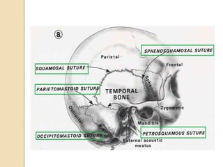 Sphenosquamosal Suture