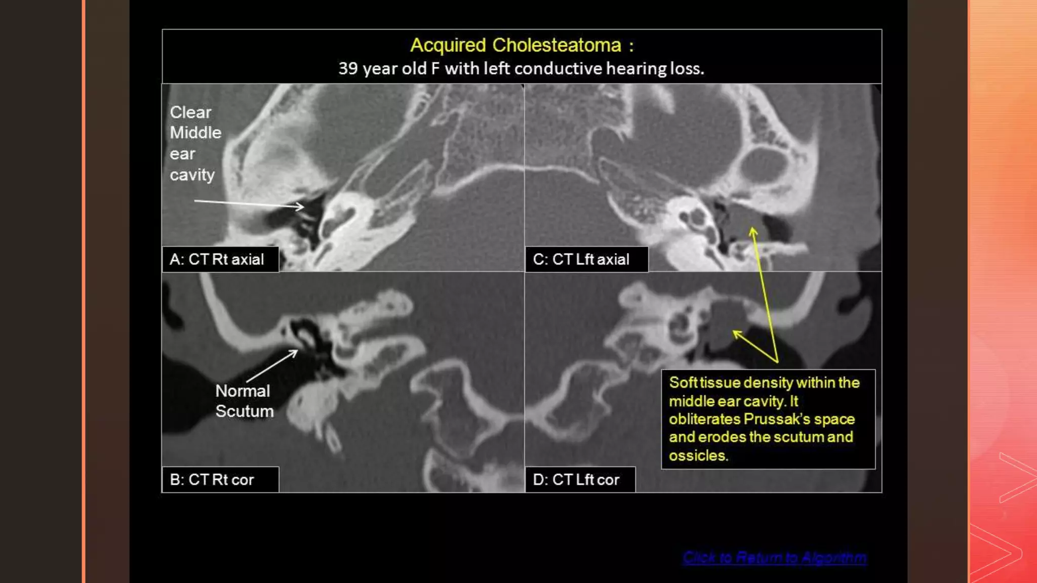 Anatomy of temporal bone final | PPTX