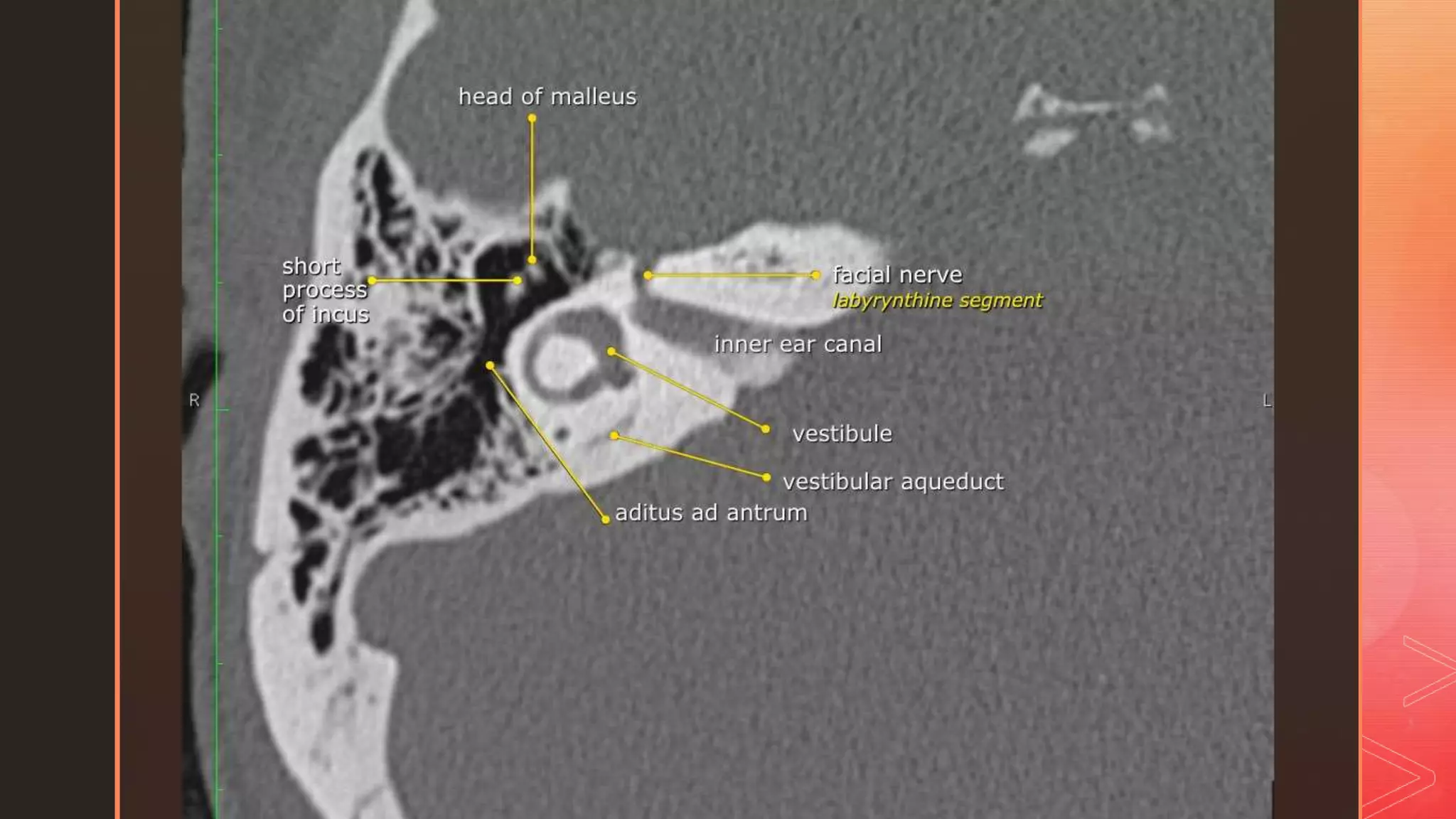 Anatomy of temporal bone final | PPTX