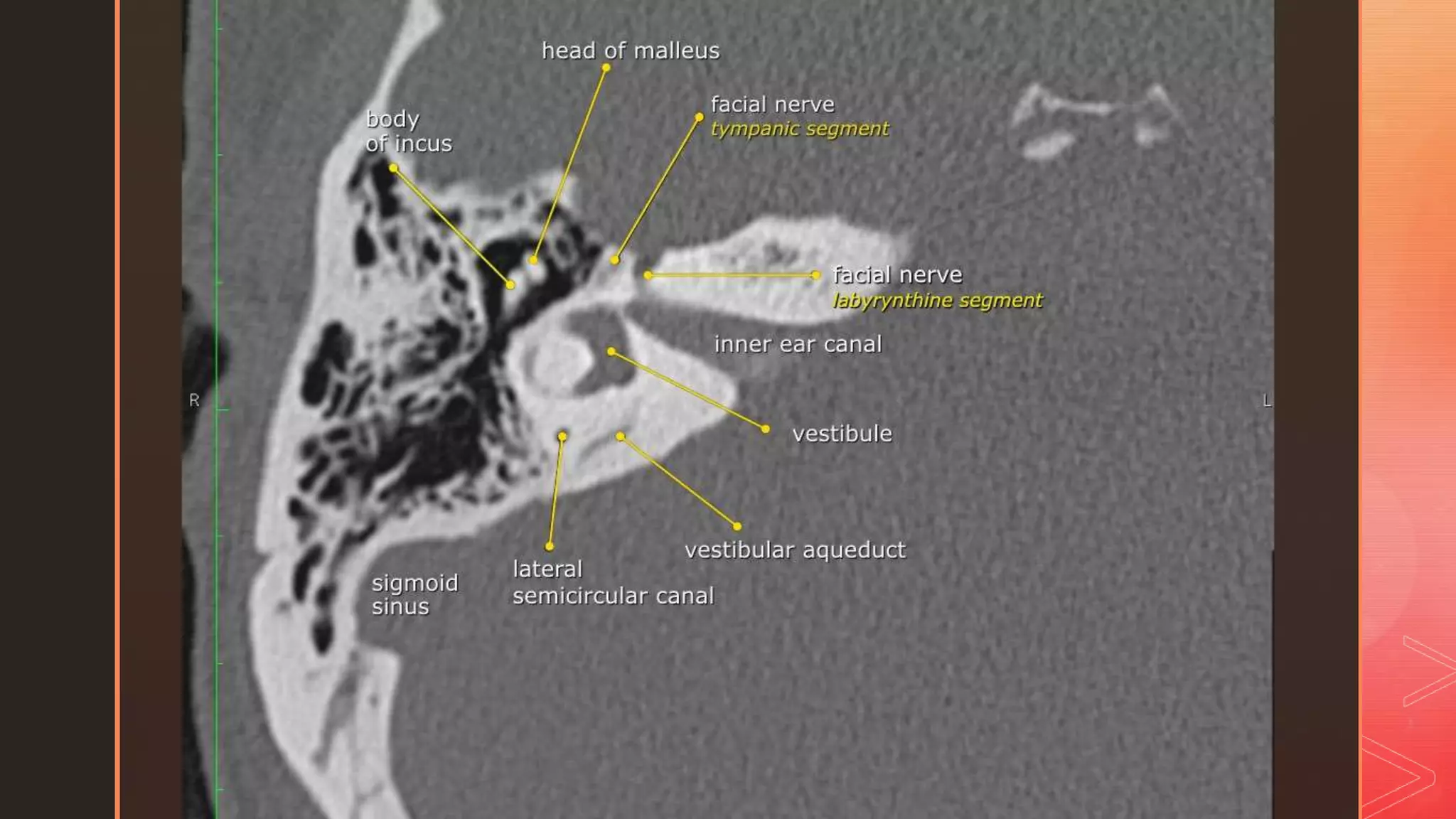 Anatomy of temporal bone final | PPTX