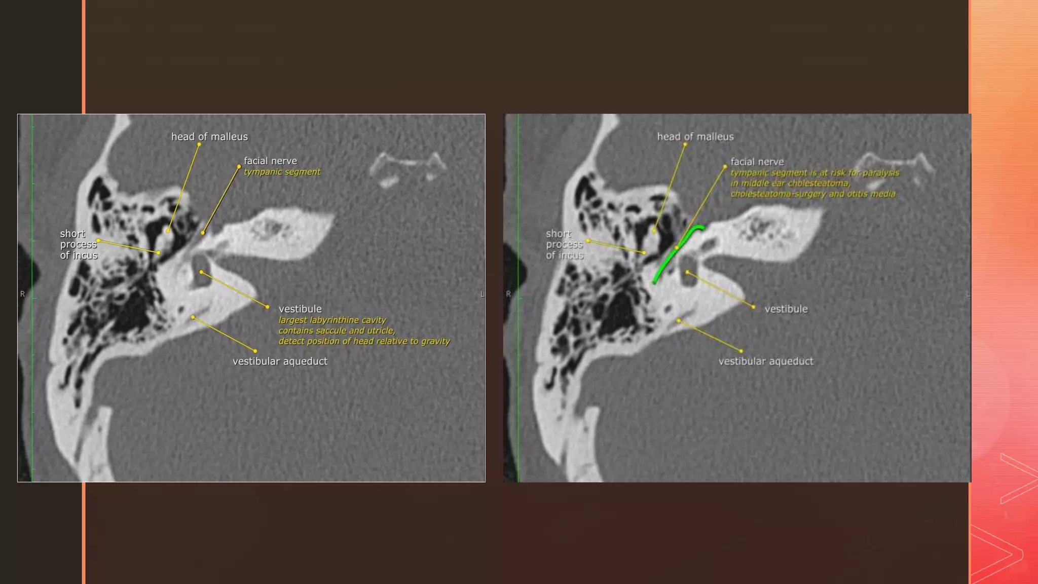 Anatomy of temporal bone final | PPTX