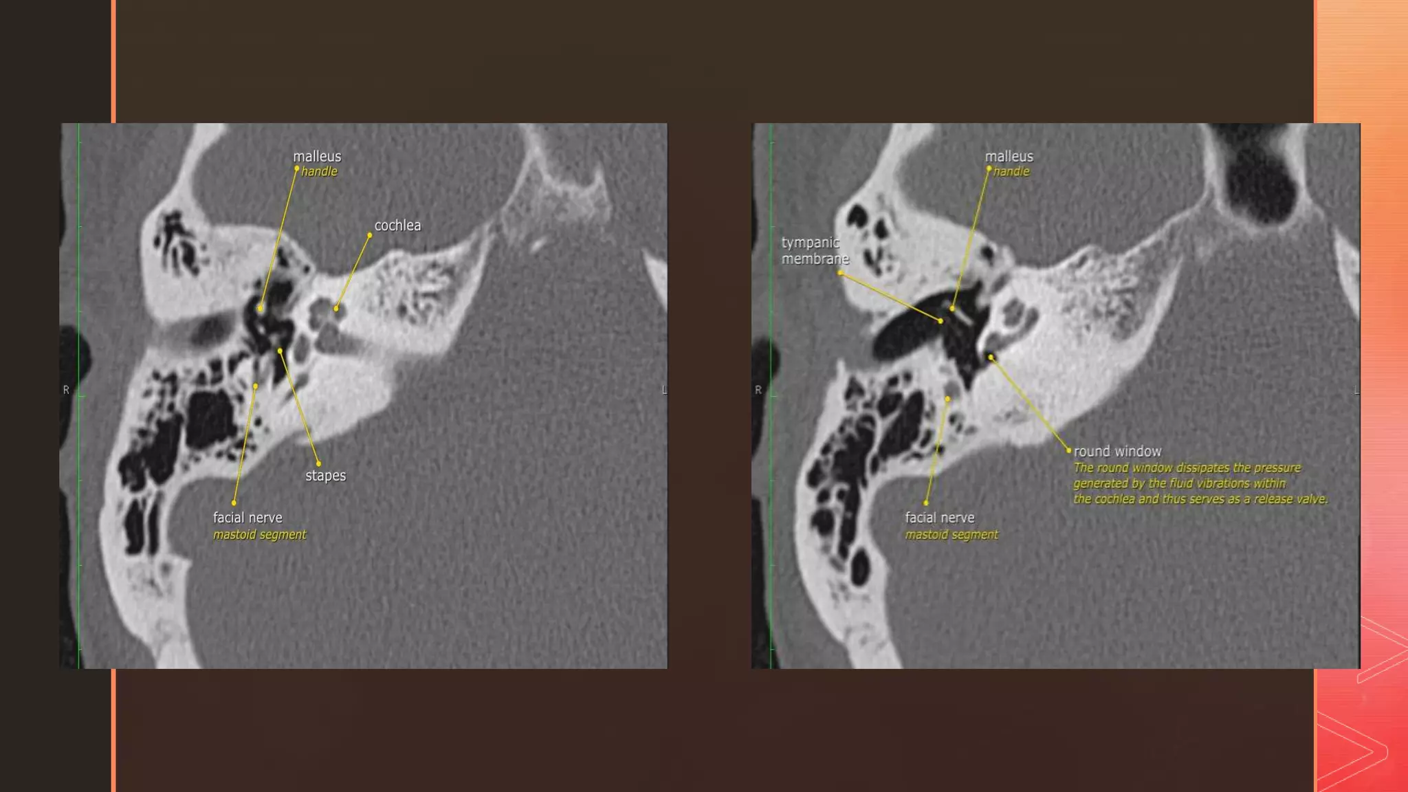 Anatomy of temporal bone final | PPTX