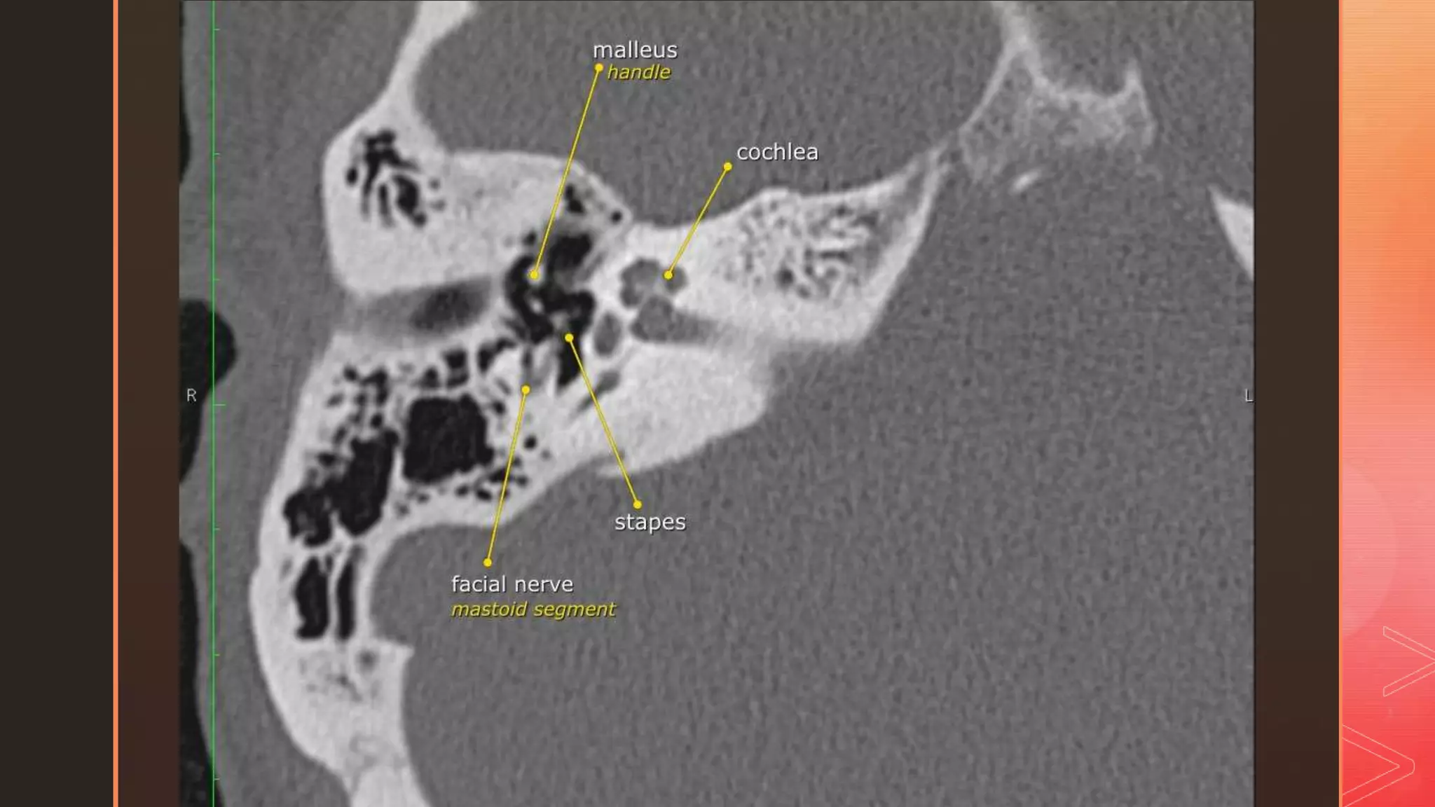 Anatomy of temporal bone final | PPTX