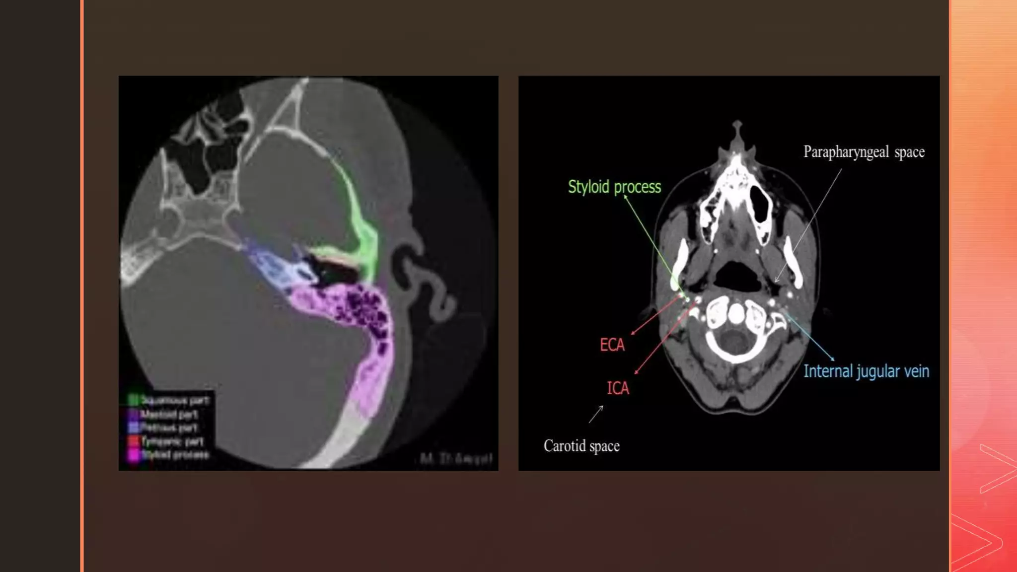 Anatomy of temporal bone final | PPTX