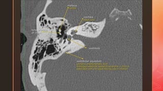 Anatomy of temporal bone final | PPTX