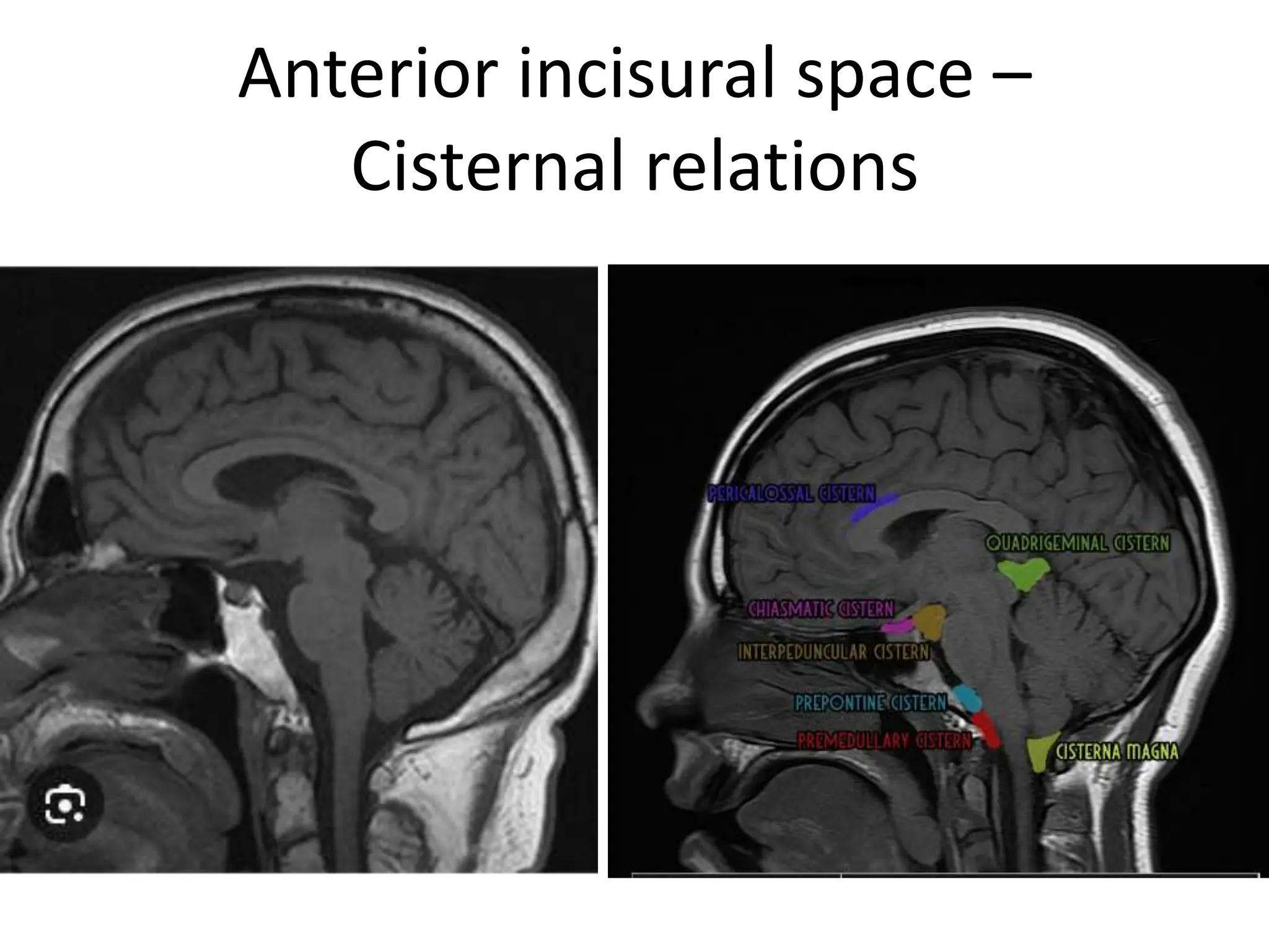 ANATOMY OF TENTORIUM INCISURA | PPTX