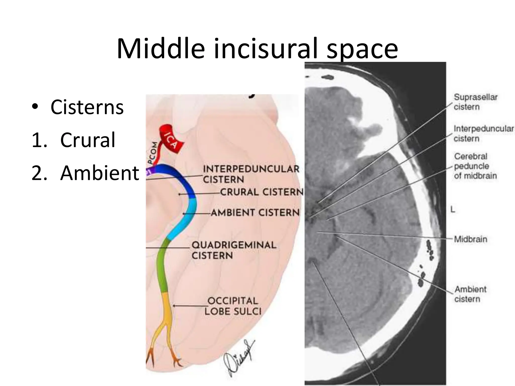 ANATOMY OF TENTORIUM INCISURA | PPTX