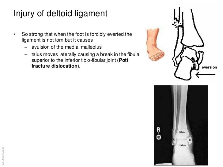Deltoid Ligament Anatomy