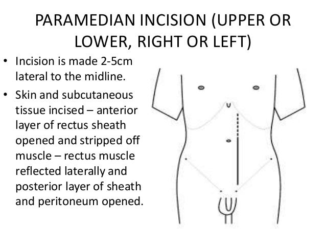 Anatomy of the anterior abdominal wall and incisions