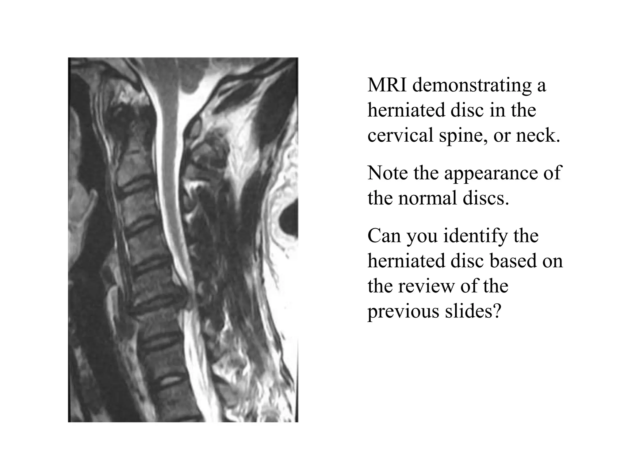 Anatomy of the Disc | PPT