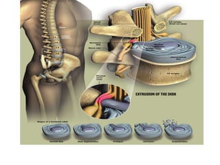 anatomy of the disc in spine anatomy complete | PPT