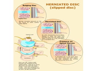 anatomy of the spinal disc - cervical .ppt