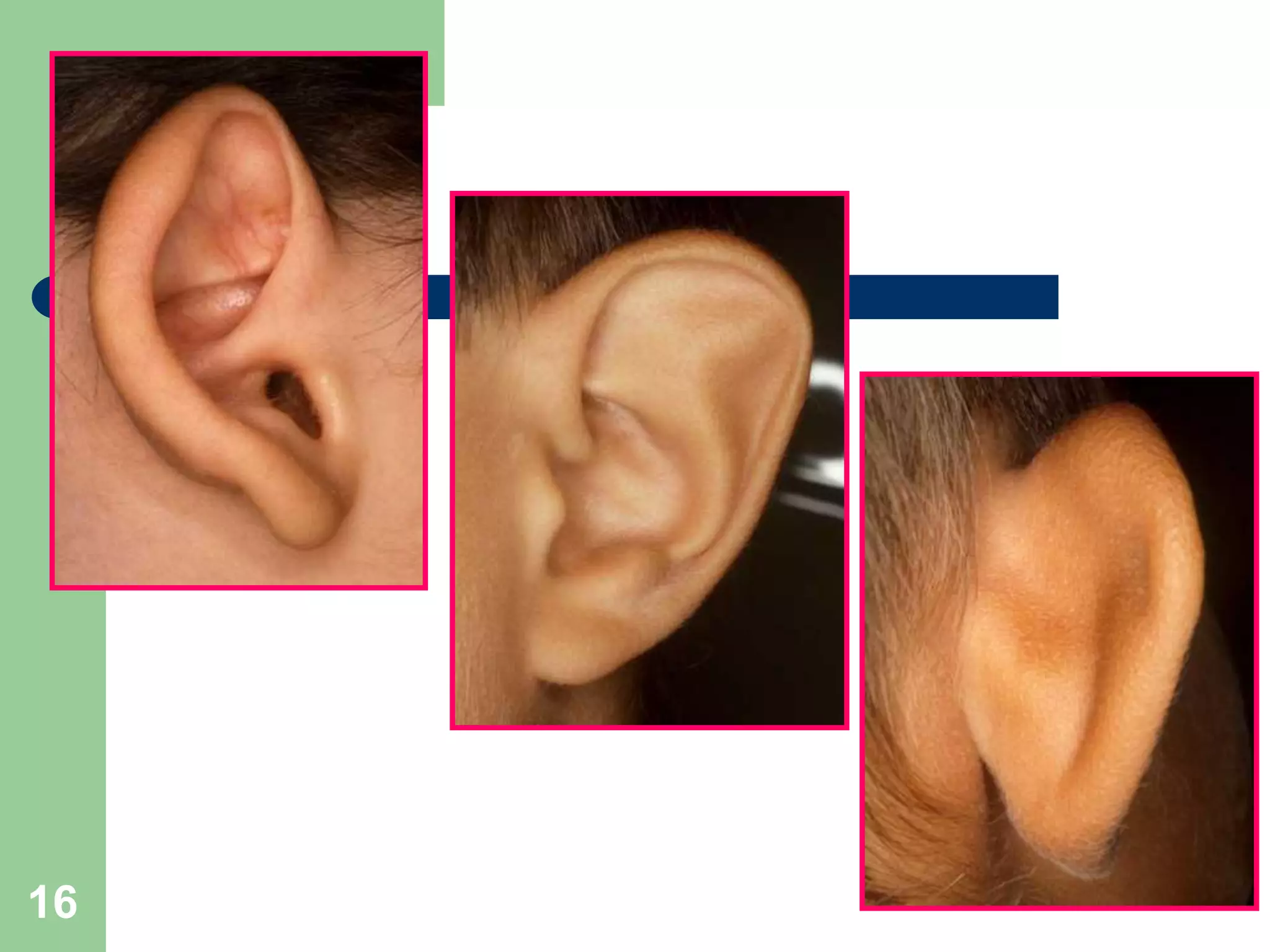 Anatomy of the external ear | PPT