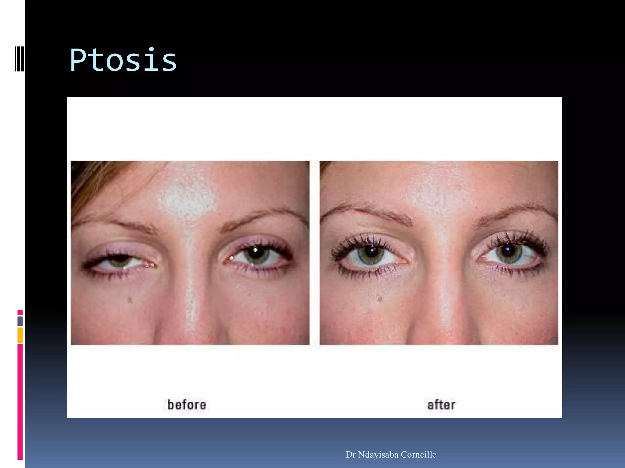 ANATOMY_OF_THE_EYE_AND_ORBITS.ppt