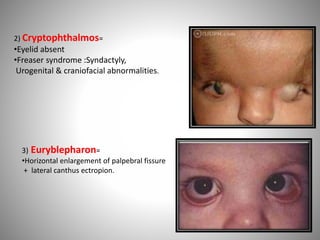 Anatomy of the eyelids. | PPT