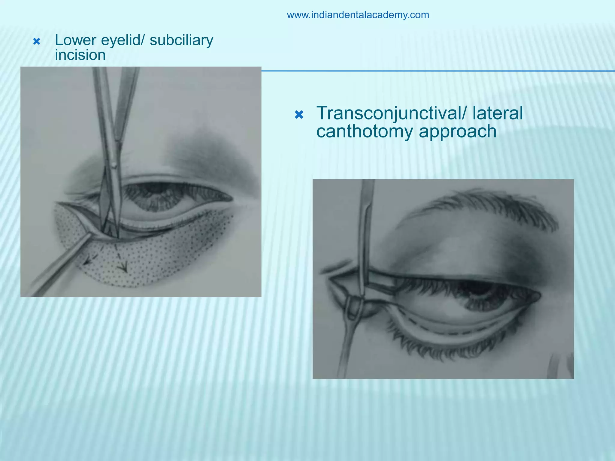 Anatomy of the maxilla and its surgical implications /cosmetic ...