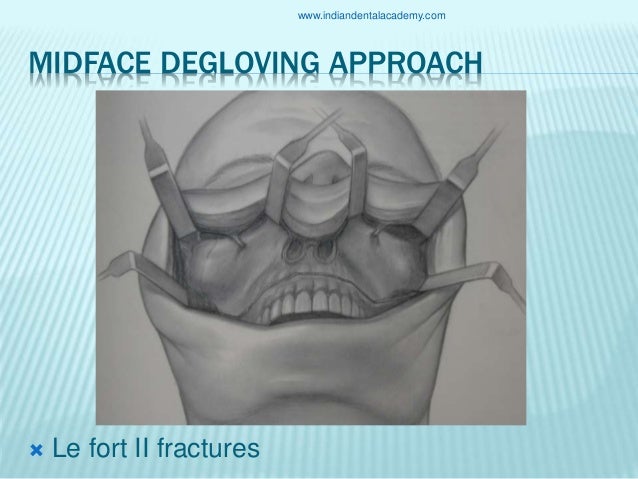 Anatomy of the maxilla and its surgical implications /cosmetic dentis…