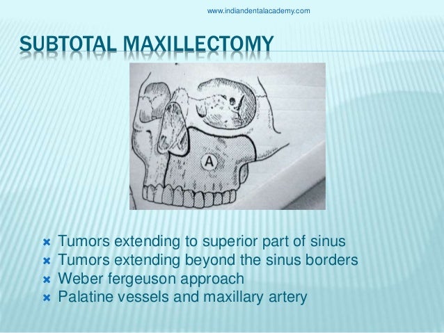 Anatomy of the maxilla and its surgical implications /cosmetic dentis…