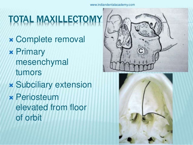 Anatomy of the maxilla and its surgical implications /cosmetic dentis…