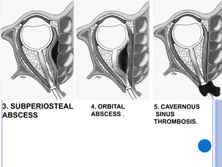 Anatomy of the orbit | PPTX